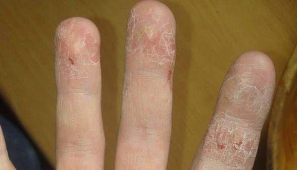 "Pękająca skóra na dłoniach to mój problem.Co robić?" - KobietaMag.pl